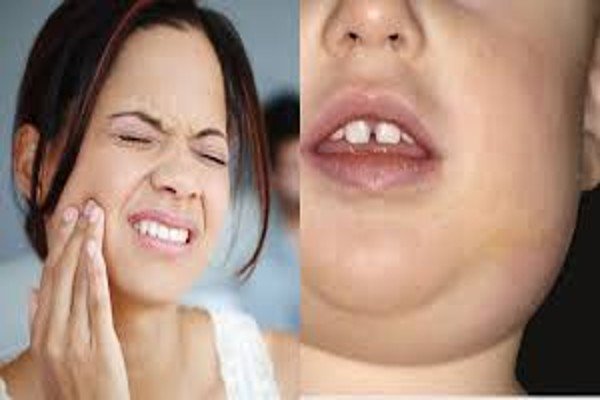 Mumps Disease :मम्प्स क्या है जानें लक्षण और उपचार - Buland Bharat Tv